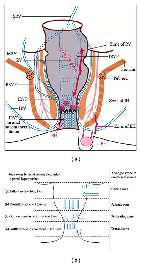 Eus Assisted Evaluation Of Rectal Varices Before Banding Pmc