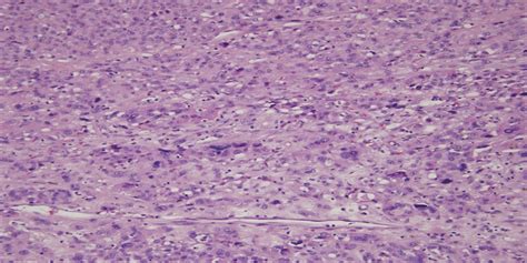 Epithelioid Leiomyosarcoma Of The Uterus Containing Sex Cord