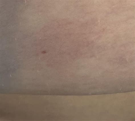 Annular Rashlesion With Central Clearing Rdermatologyquestions