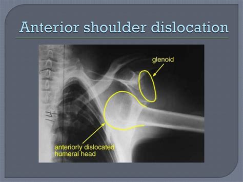 Ppt Shoulder Anatomy Powerpoint Presentation Free Download Id2038249