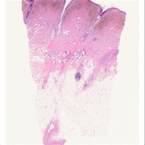 Lateral View Of Scalp Demonstrating Heterogeneity Of Texture Among Lesions Download