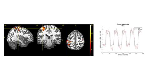 Ge Unveils Three New Mri Technologies At Ismrm