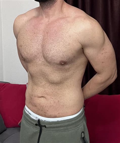 10 Months Post Gyno Surgery Rgynecomastia