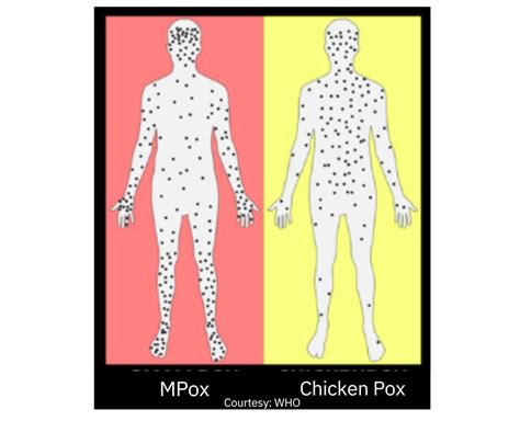 Mpox Monkeypox Symptoms Transmission Prevention And Treatment 2025