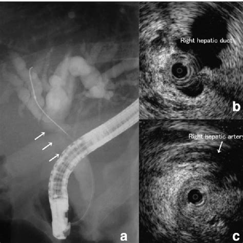 Pdf Residual Gallbladder Cancer Emerging After Subtotal
