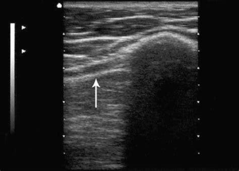 Emed 5 Msk And Soft Tissue Ultrasound Flashcards Quizlet
