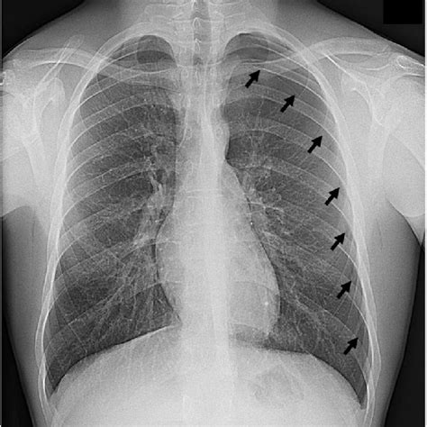 Large Right Sided Pneumothorax With Maximum Separation From The Apex Of