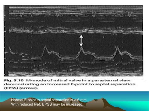 PPT Echocardiographic Assessment Of LV Systolic Function PowerPoint