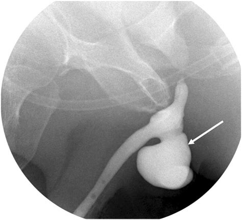Fluoroscopic Retrograde Urethrogram Shows A Large Diverticulum At The