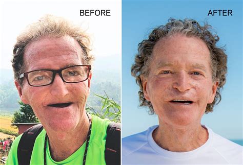 Jaw In A Day Surgery Restores Squamous Cell Carcinoma Survivors Face