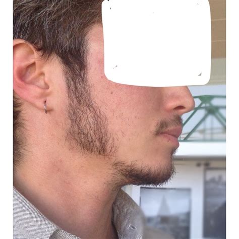 Patchy Beard Success Stories Before And After Photos Page 18 Beard Board