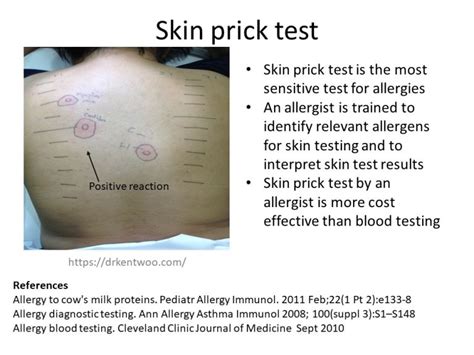 Skin Prick Test Dr Kent Woo