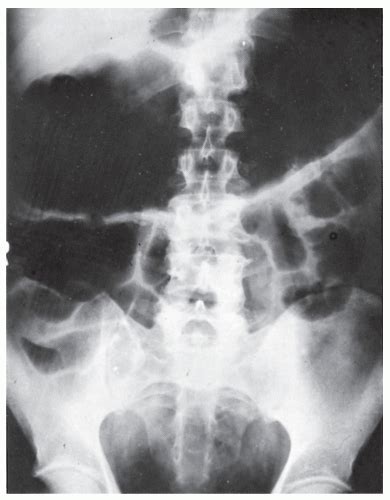 Ulcerative Colitis Abdominal Key