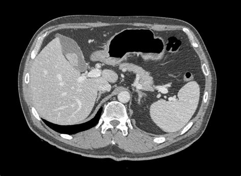 Axial Computed Tomography Slice Of The Patient It Shows A Polypoid Download Scientific Diagram