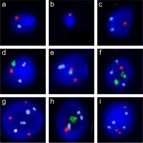 Examples Of Signal Patterns Of Chromosomal Numerical Abnormalities Download Scientific Diagram Examples Of Signal Patterns Of Chromosomal Numerical Abnormalities Download Scientific Diagram