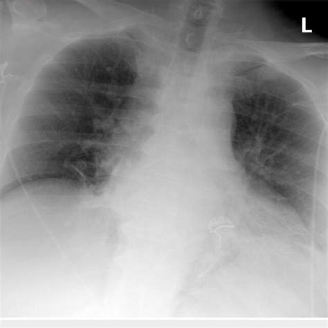 Cxr Showing Left Lung Atelactasis Pleural Effusion Download Scientific Diagram