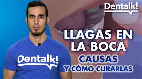 Descubre Por Qué Se Producen Las Llagas En La Boca Y Cómo Prevenirlas Rayan Clinic