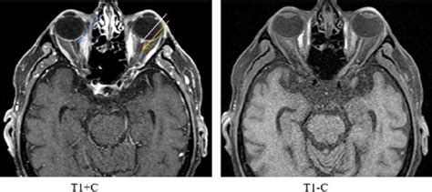 T1 Weighted Pre And Postcontrast Axial Mri Of The Orbits Demonstrated A