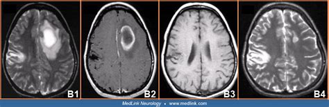 Tumefactive Demyelinating Lesions Medlink Neurology
