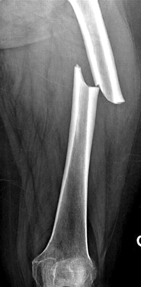 Femoral Shaft Fractures Trauma Orthobullets