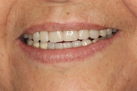 Removable Partial Dentures Yardley PA