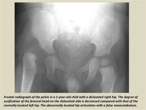 Presentation1 Radiological Imaging Of Developmental Dysplasia Of The