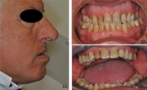 Extraoral Examination Shows A Concave Class Iii Profile A While The