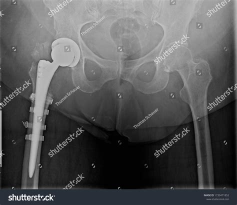 Follow Posterior Anterior View Hip Xray Shutterstock