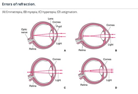 Principles Of Refractive Errors Al Salem Eye Clinic