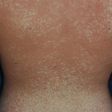 Extensive Confluent Scaly Erythema With Follicular Accentuation And Download Scientific Diagram