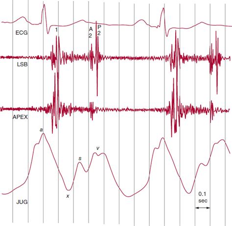 Tricuspid And Pulmonic Valve Disease Thoracic Key