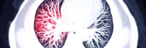 Distinguishing Ct Scan Differences In Pulmonary Tuberculosis Based On
