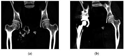 Acetabular Implant Finite Element Simulation With Customised Estimate Of Bone Properties