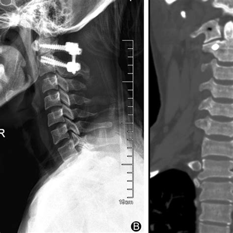 The Postoperative Anteroposterior A And Lateral B Radiographs