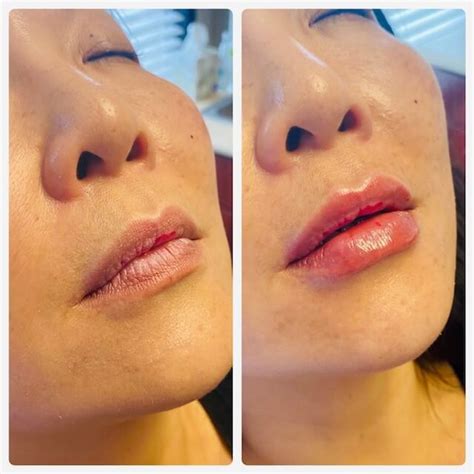 Results Robert Andrews Laser And Medical Aesthetics