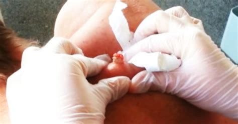 Man Gets 30 Year Old Cyst Exploded Off Of Back Thatviralfeed