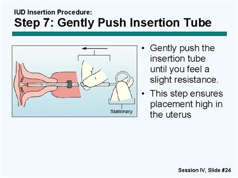 Copperbearing Intrauterine Devices Iuds Session Iv Practicing Iud
