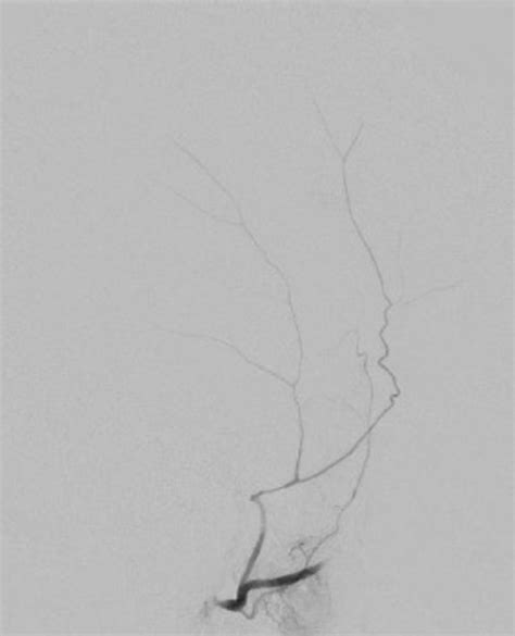 Subdural Hematoma Preventing Recurrence With A Three Step Onyx Embolization