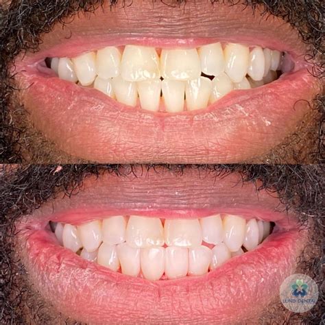 Bioclear 1 Session 3 Lower Anterior Teeth Ever Smile And See A Dark