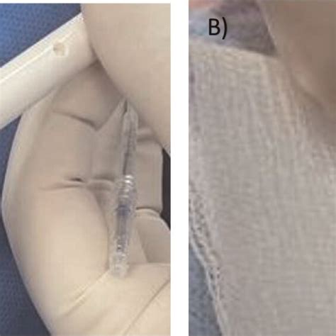 Active Fixation A And Passive Fixation B Pacemaker Leads