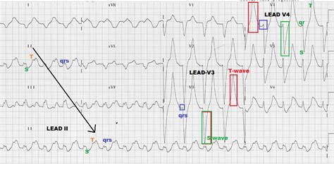 Mas Pharmacy Review Health Times Ecg In Hyperkalemia