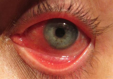 Conjonctivite Allergique Protégez Vos Yeux Des Pollens Avec Ces
