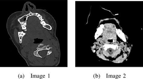 Figure 1 From Comparison Results Of Medical Image Segmentation With Genetic Algorithm And