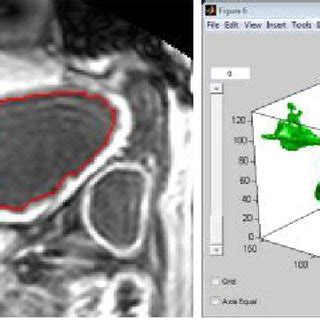 Example Of The Bowel Surface Segmentation Left Original Data Right 3D