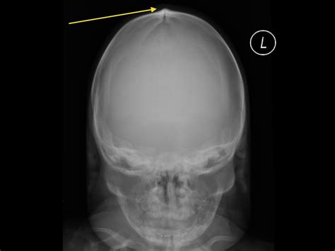 Lambdoid Suture X Ray