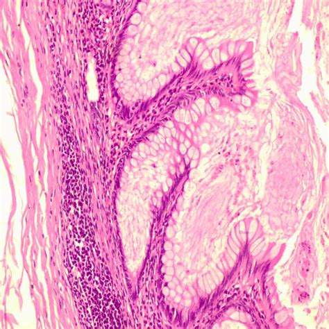 In The Lamina Propria It Is Observed That Lymphoid Tissue Decreases Download Scientific