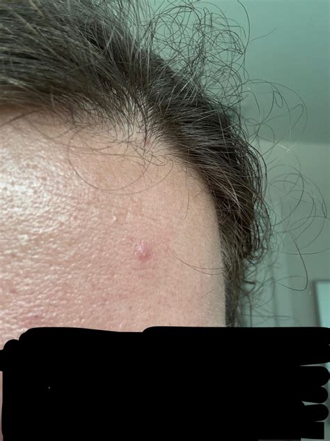 Bubble Like Pimple R Acne