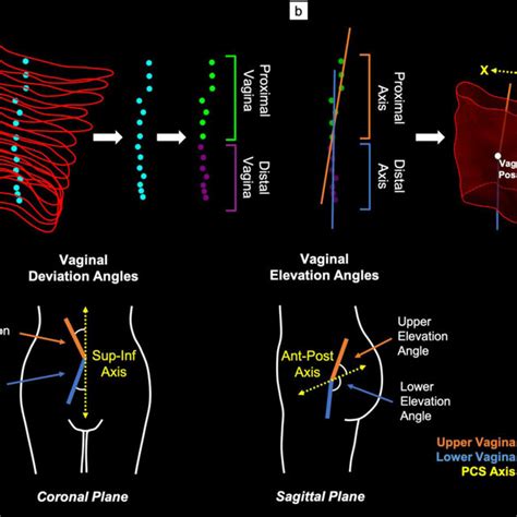 Calculation And Definition Of The Vaginal Angles A The Central Axis