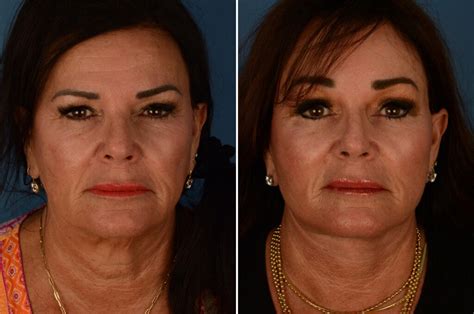 Endoscopic Facelift At Josephine Parks Blog