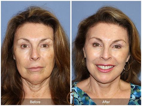Patient 315322 Facelift 60s Before And After Photos Dr Kevin Sadati
